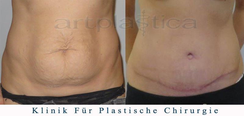 Bilder Von Narben Einer Bauchdeckenstraffung Nach 2 Jahren Bilder Von Narben Einer Bauchdeckenstraffung Nach 2 Jahren